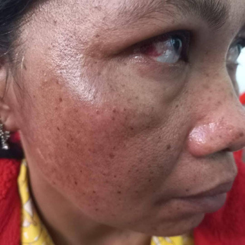 Drunk Man Attacks Neighbor with Slingshot in Takeo - Cambodia Expats Online