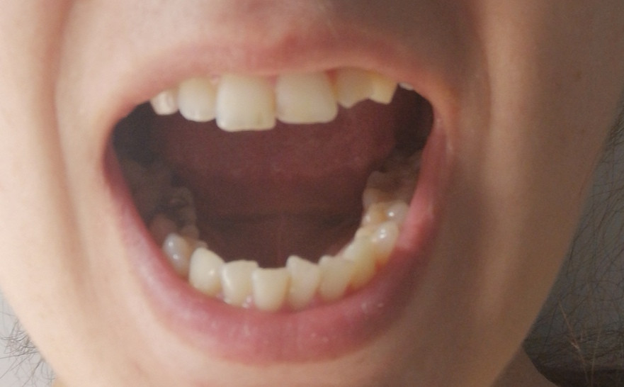 Tray 1 - LET'S GO! 😁 : r/Invisalign